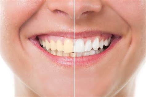 Teeth Whitening Gum Does It Actually Work Elite Smiles