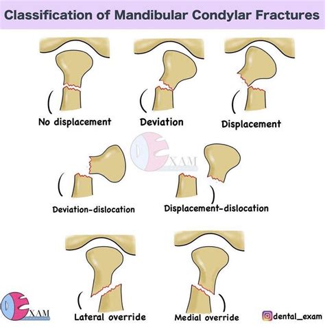Dental Condylar Fracture Classification Facebook