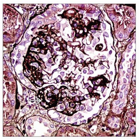 Focal Segmental Glomerulosclerosis Classification Basicmedical Key