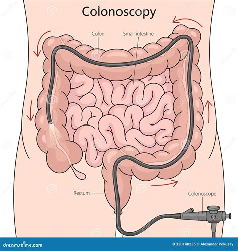 Colonoscopy Procedure Diagram Medical Science Stock Vector
