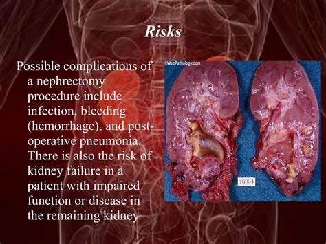 Nephrectomy Ppt