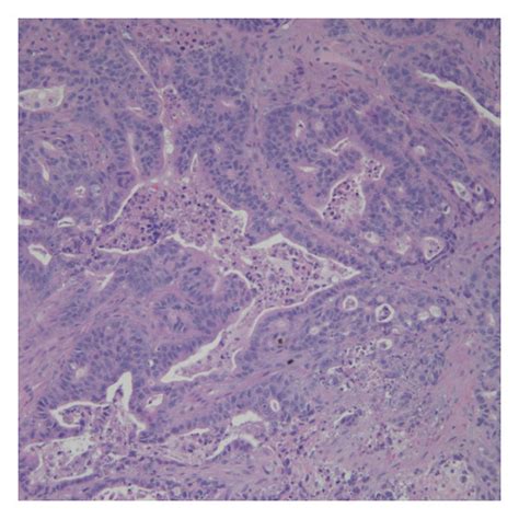 Pathologic Specimen Of The Retromolar Trigone Biopsy 2a 100x