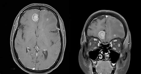 Ultimate Radiology Hemorrhagic Dural And Parenchymal Metastases Brain
