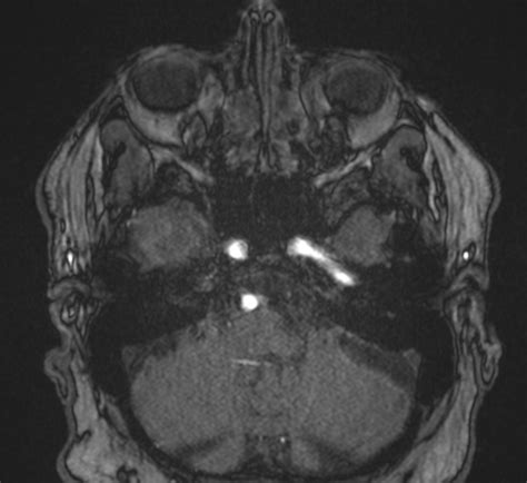 Basilar Artery Dissection Radiopaedia 77032 88976 Axial Tof Nc Commons