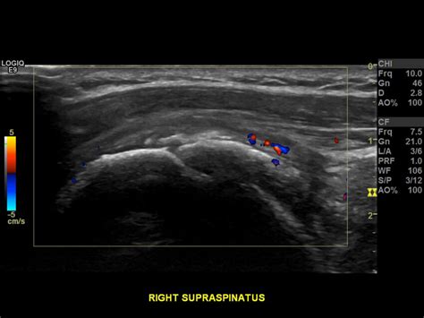 Radiopaedia Case Calcific Supraspinatus Tendinitis And Bursitis Id