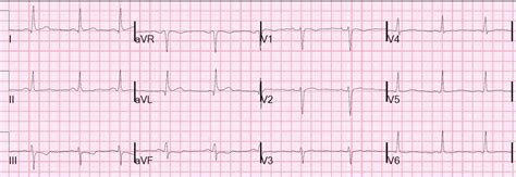 Subtle Lateral St Elevation False Positive This Diagnosis Is Hard