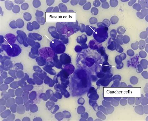 Gaucher Cells Successful Treatment Of Gaucher Disease Type 1 By Enzyme