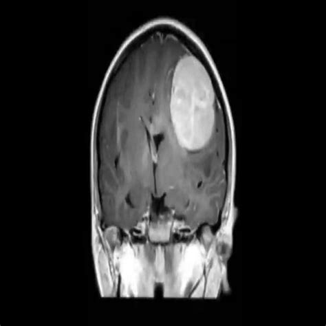 brain tumor detection object detection dataset v2 mahitha by brain tumor