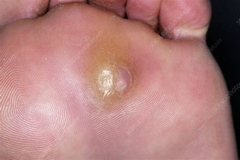 Verruca Stock Image C018 7161 Science Photo Library