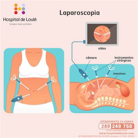 O Que é Uma Laparoscopia Clínica Internacional De Olhão