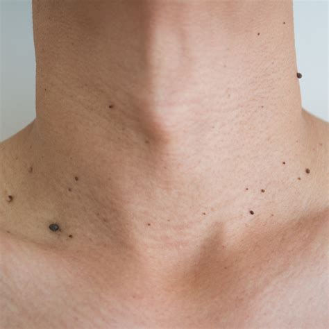 Warts Vs Skin Tags Whats The Difference And When To Treat Them