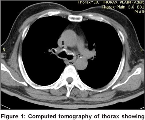 Tracheal Calcification Semantic Scholar