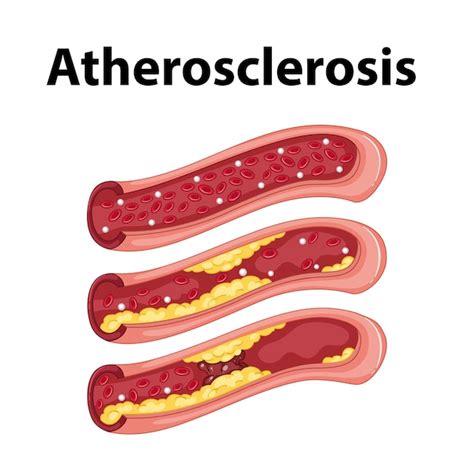 Premium Vector Science Education Human Anatomy And Atherosclerosis