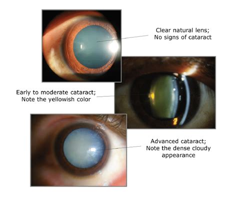 Cataracts 101 The Basics Of Cataract Surgery And What To Expect