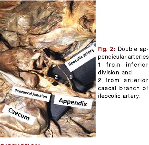 Appendicular Artery