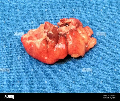 Appendix Removal Surgery Perforated Appendix Removed From A Patient