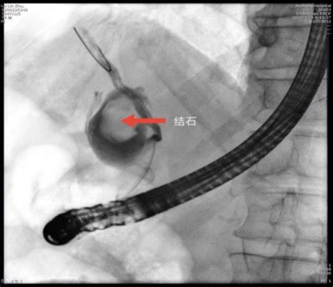 Ercp——胆胰疾病首选的微创治疗 金医病例 复旦大学附属金山医院