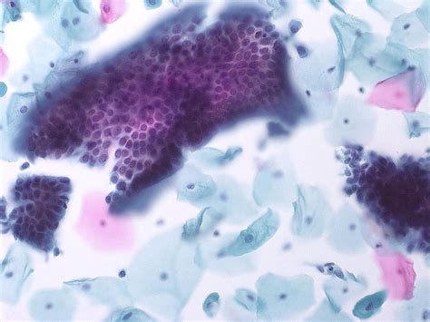Fig 619 Negative For Intraepithelial Lesion Or Malignancy