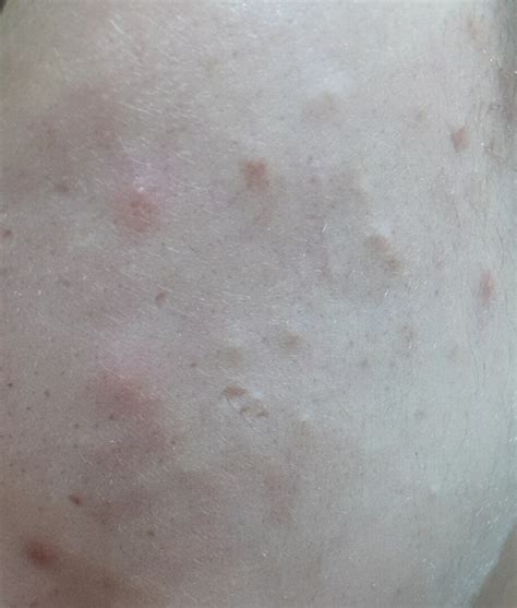 블라인드 패션·뷰티 박혀있는 피지같은 건성 여드름 피부과 치료 효과 있나요 아니면 포기