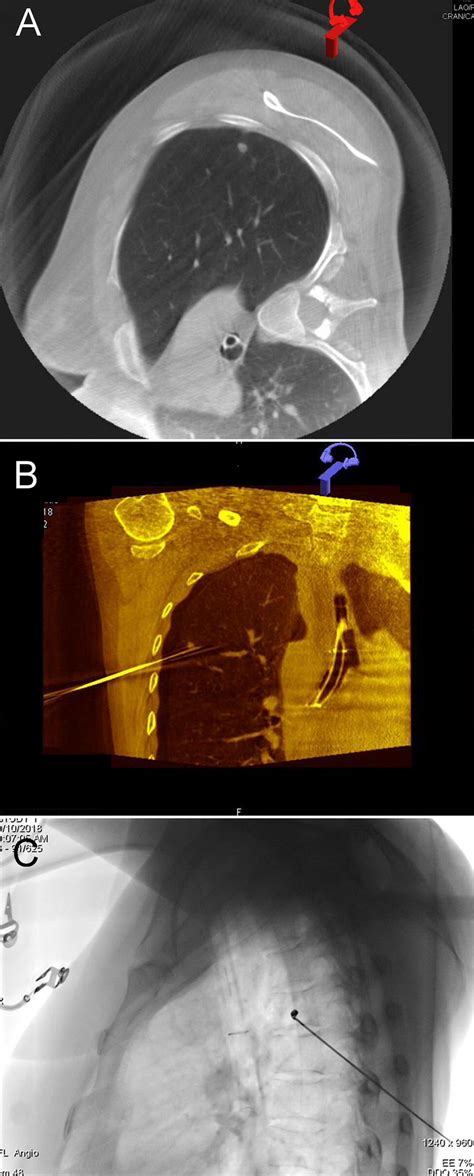 A Cone Beam Ct Image Of A Lung Nodule Obtained With The Patient Placed Download Scientific
