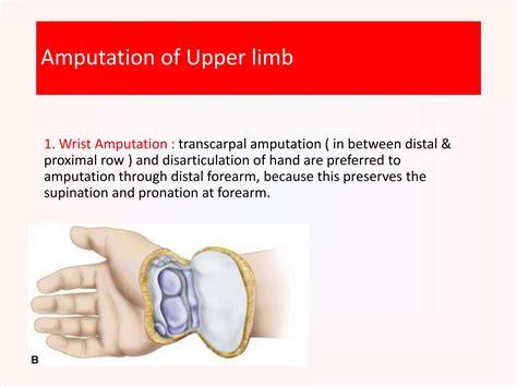 Amputation And Disarticulation Pptx