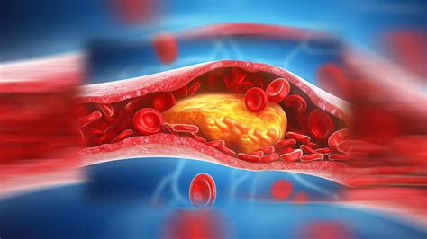 Peripheral Artery Disease Pad And Diabetes What You Need To Know