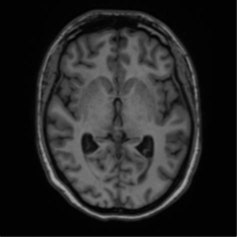 Cavernoma With Bleed Midbrain Radiopaedia 54546 60774 Axial T1 Nc Commons