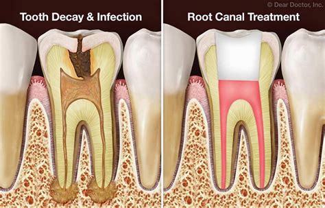 Irrigation Sequence In Root Canal Treatment At David Mroz Blog