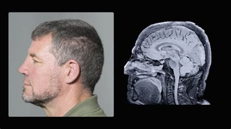 Inside The Brain Of A Suspected Cte Patient 3d Scans Show Impact Of