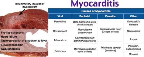 Myocarditis
