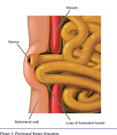Table 2 From Parastomal Hernia Incidence Prevention And Treatment Strategies Semantic Scholar