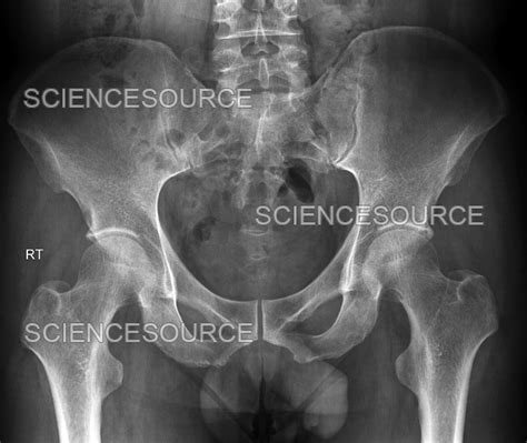 Normal Pelvis X Ray