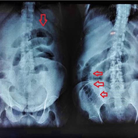 Specimen Showing An Intraluminal Polyp Download Scientific Diagram