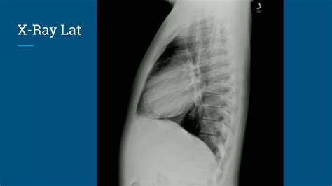 Calcific Constrictive Pericarditis Pptx