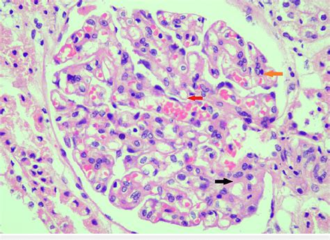 Light Microscopic Image H And E Staining X40 Thickened Glomerular