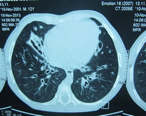 Impact Of Cystic Versus Cylindrical Types Of Bronchiectasis On Pulmonary And Cardiac Functions