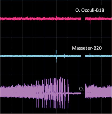 Introduction To Intraoperative Neurophysiological Monitoring For Anaesthetists Virtual Library