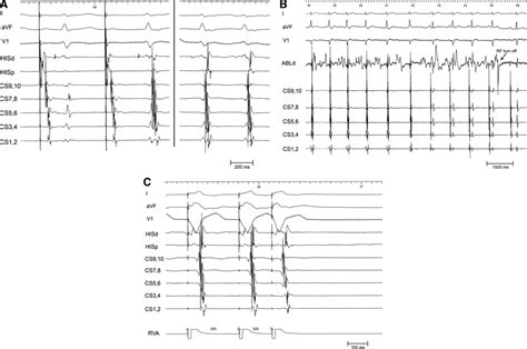 Atrioventricular Block During Slow Pathway Ablation Circulation Arrhythmia And Electrophysiology