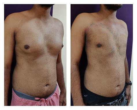 Gynecomastia Surgery Cost In Bangalore India Venkat Center For