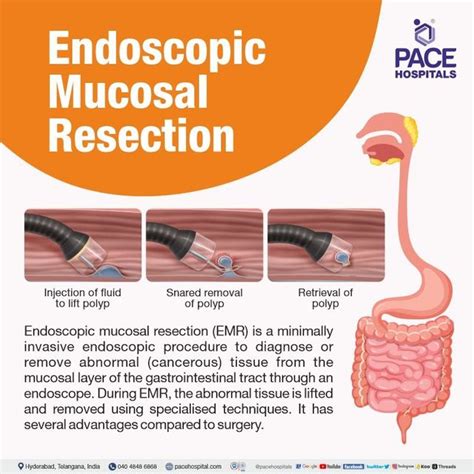 Endoscopically Resectable