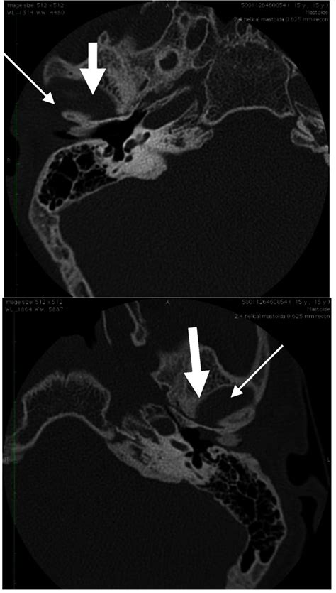 Bilateral External Ear Canal Osteomas Discussion On A Clinical Case Pmc