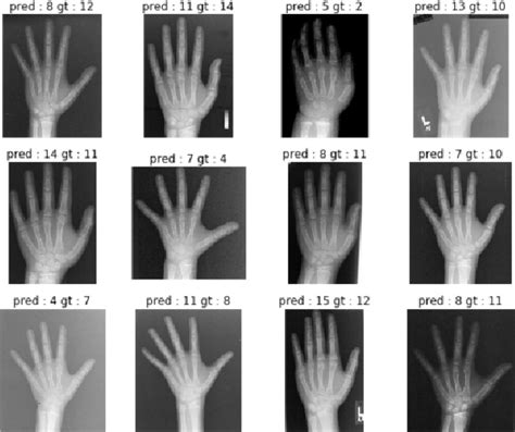 Figure 1 From Automated Bone Age Classification With Deep Neural