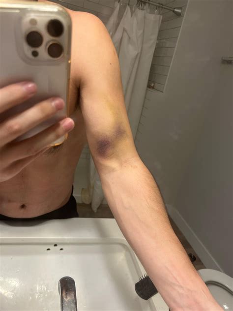 Donating Plasma Side Effects R Plassing