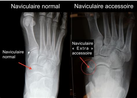 Radiographie Des Os Du Pied Membre Inférieur Radiographie