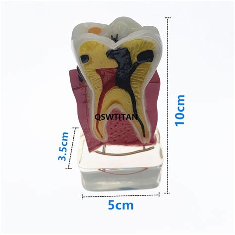 Teeth Model 4 Times Tooth Pathology Model Comprehe Grandado