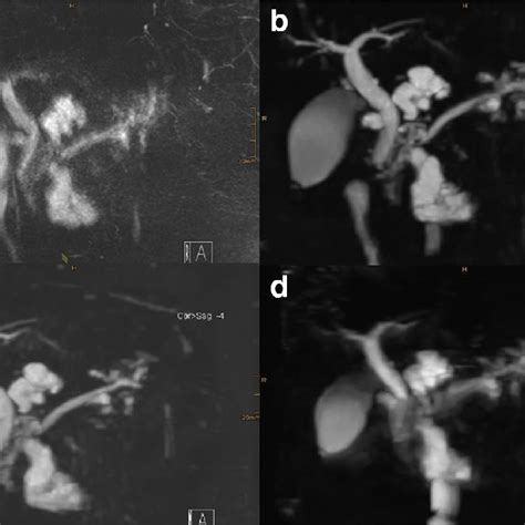 A 71 Year Old Female Patient With Multiple Bd Ipmn A Conventional Download Scientific Diagram