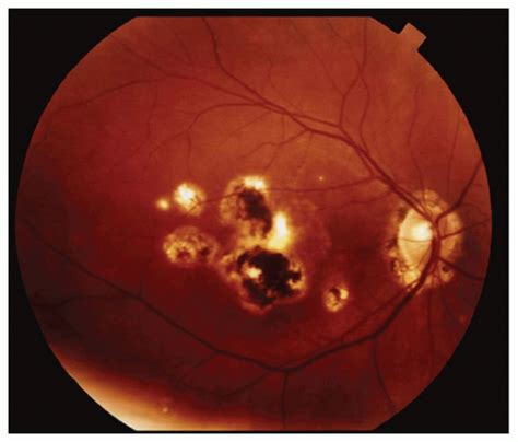 Retina And Vitreal Disease Ento Key