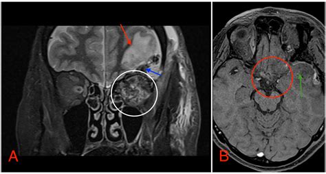 Optic Nerve Glioblastoma With Optic Chiasm Involvement A Case Report