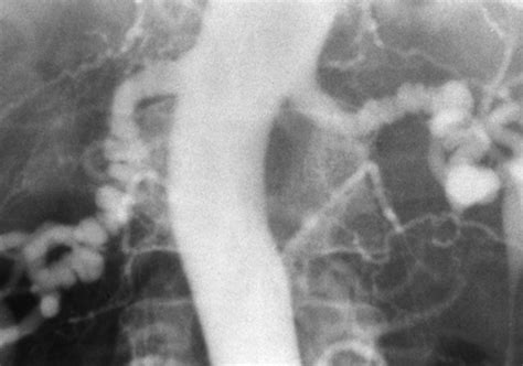 Polyarteritis Nodosa Pan And Polymyalgia Rheumatica Pmr Flashcards Quizlet