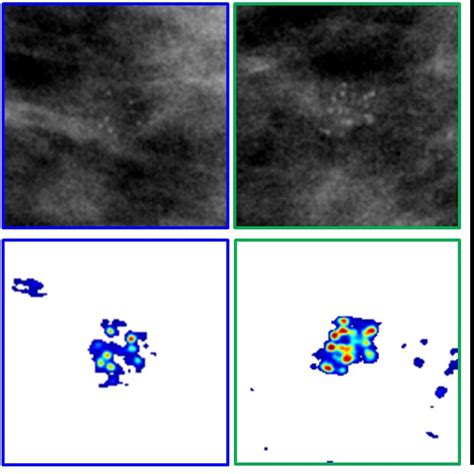 Accurate Segmentation Allows To Easily Compare Between Mammograms Of